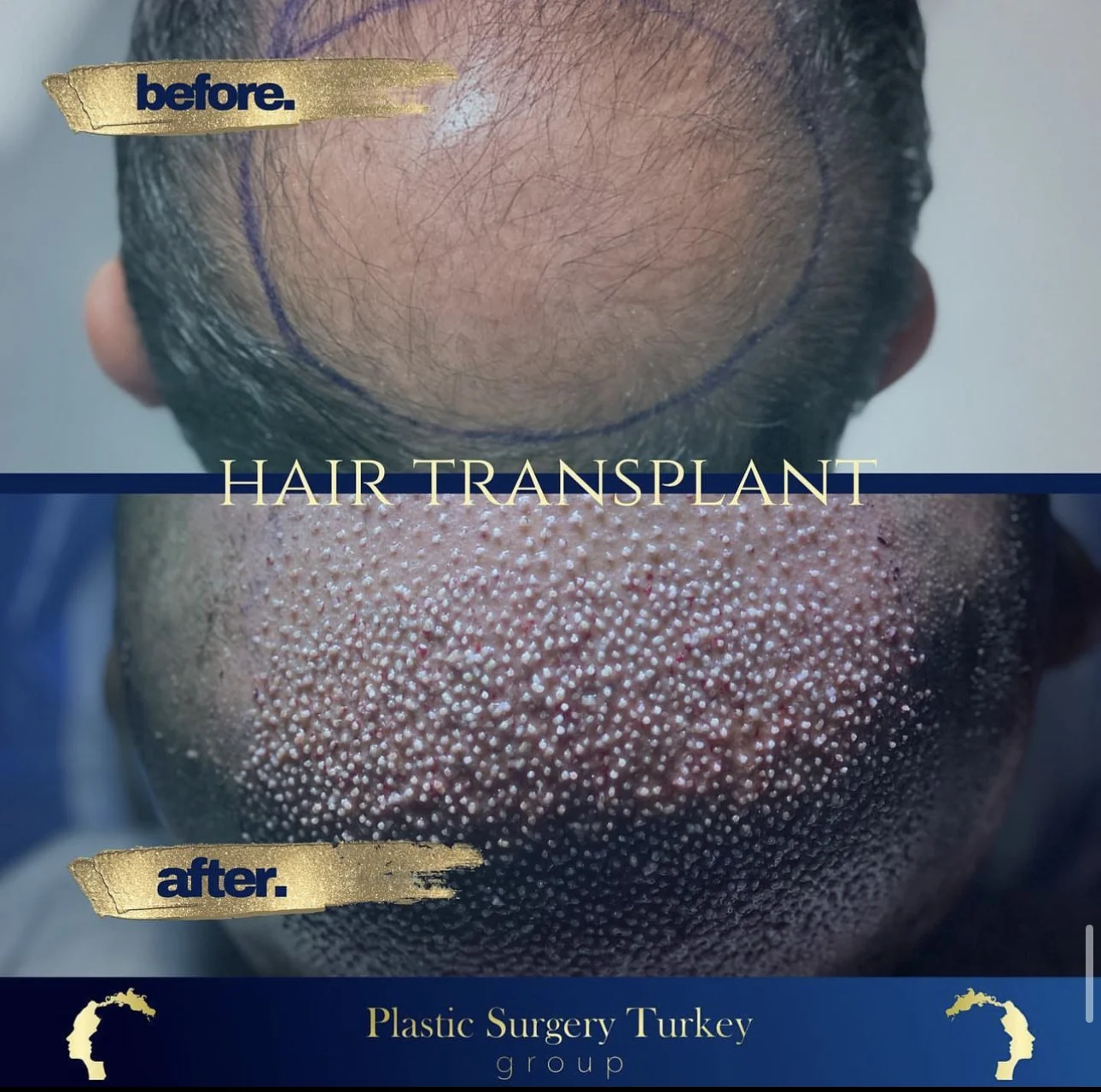 Expert Plastic Surgery in Turkey - Top Surgeons & Advanced Care | PSTG